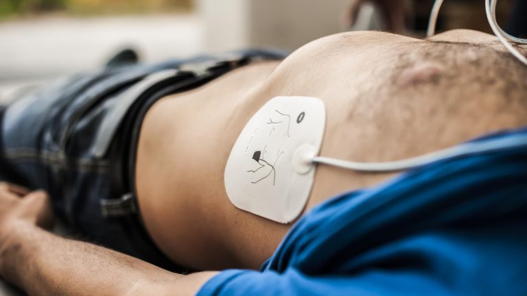 Where Should AED Pads Be Placed on an Adult? Answered